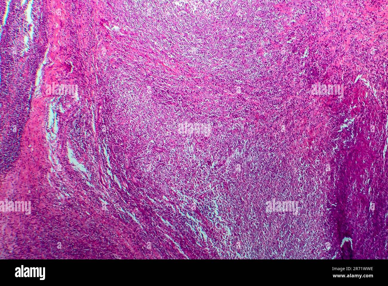 Hodgkin's lymphoma, light micrograph, photo under microscope Stock ...