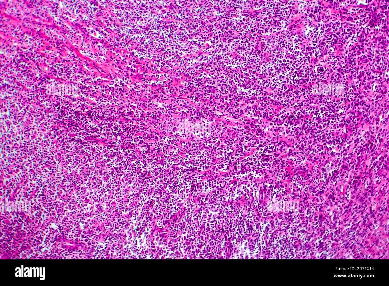 Hodgkin's lymphoma, light micrograph, photo under microscope Stock ...