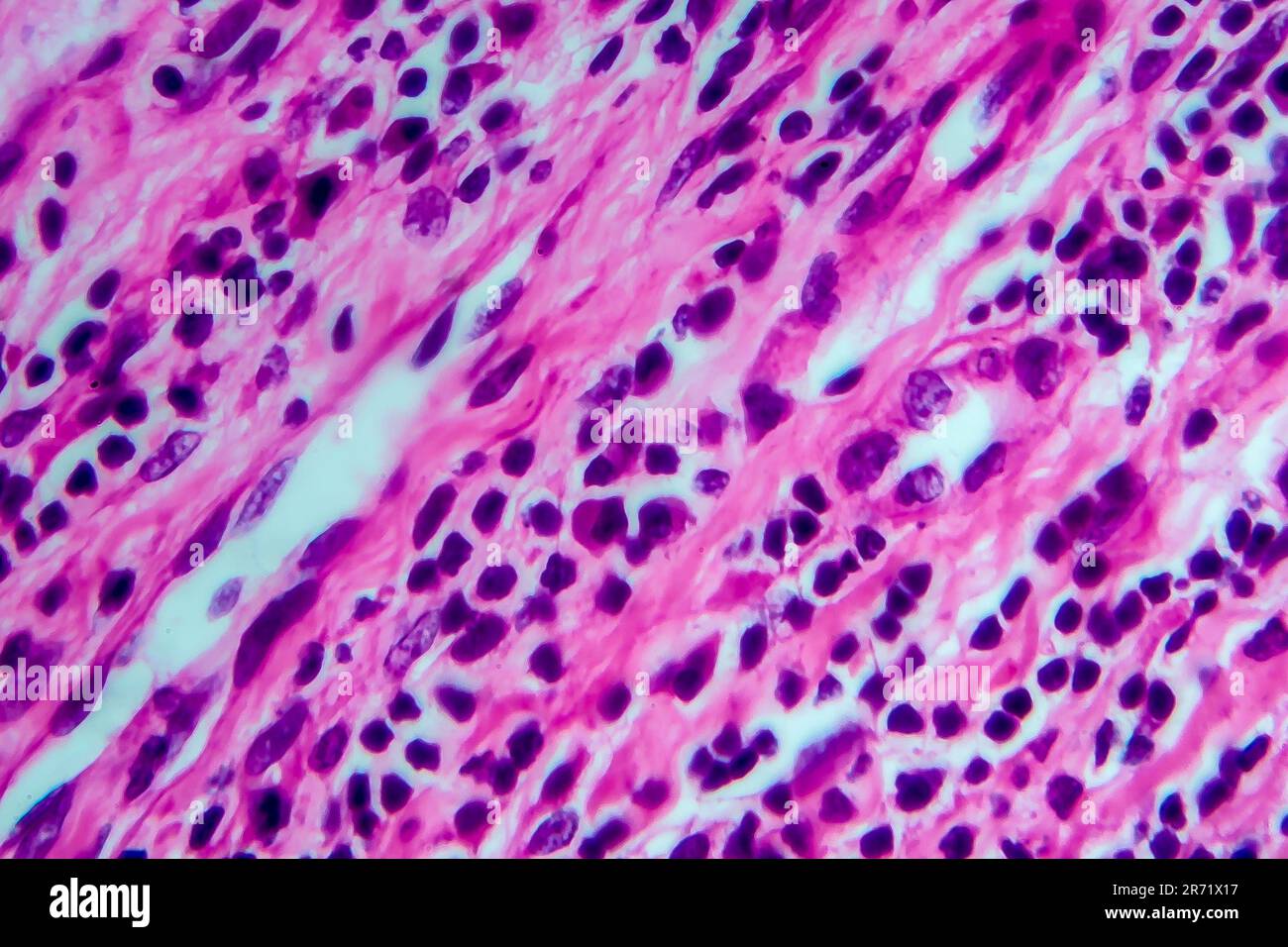 Hodgkin's lymphoma, light micrograph, photo under microscope. High ...