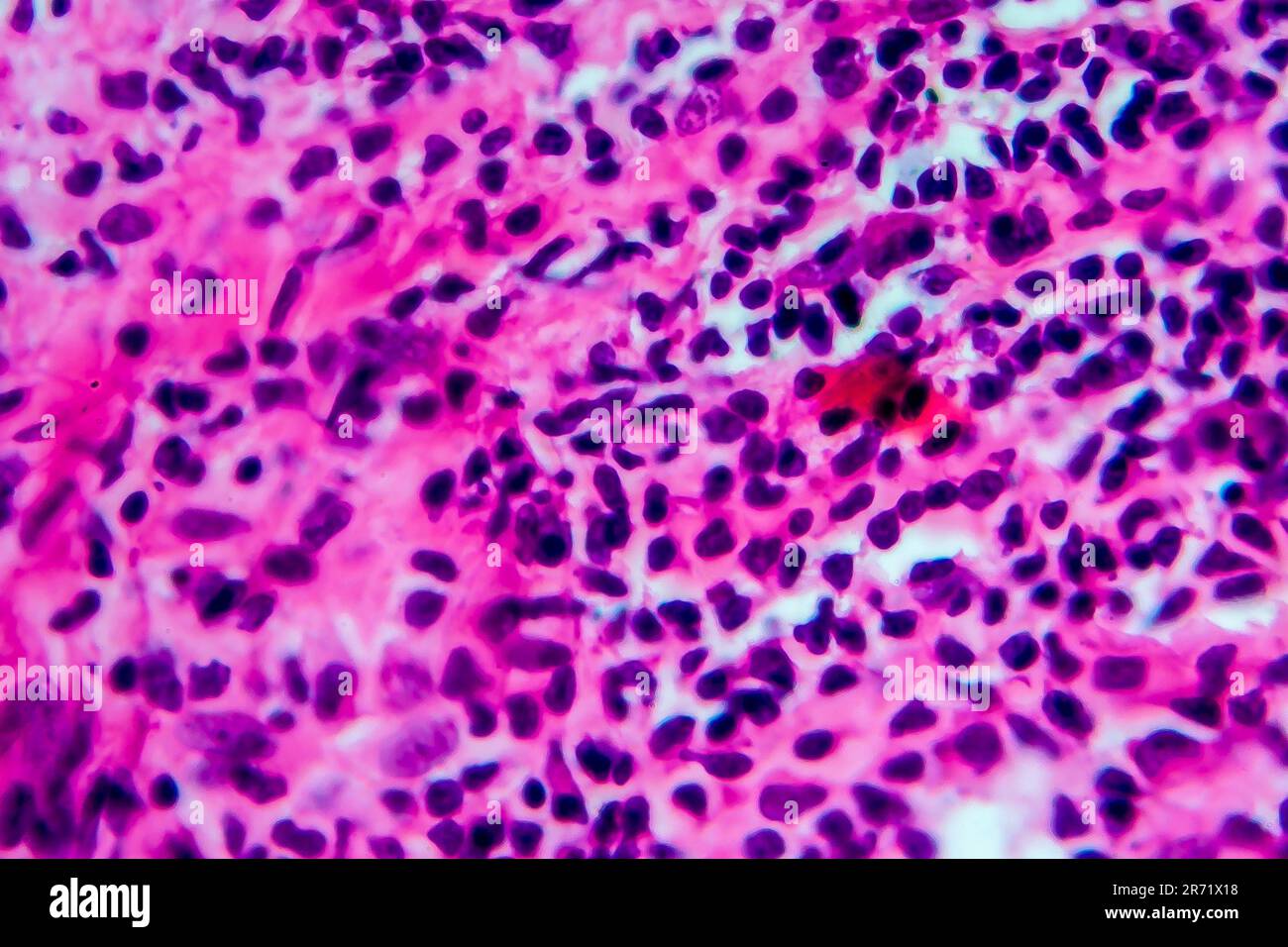 Hodgkin's lymphoma, light micrograph, photo under microscope. High ...