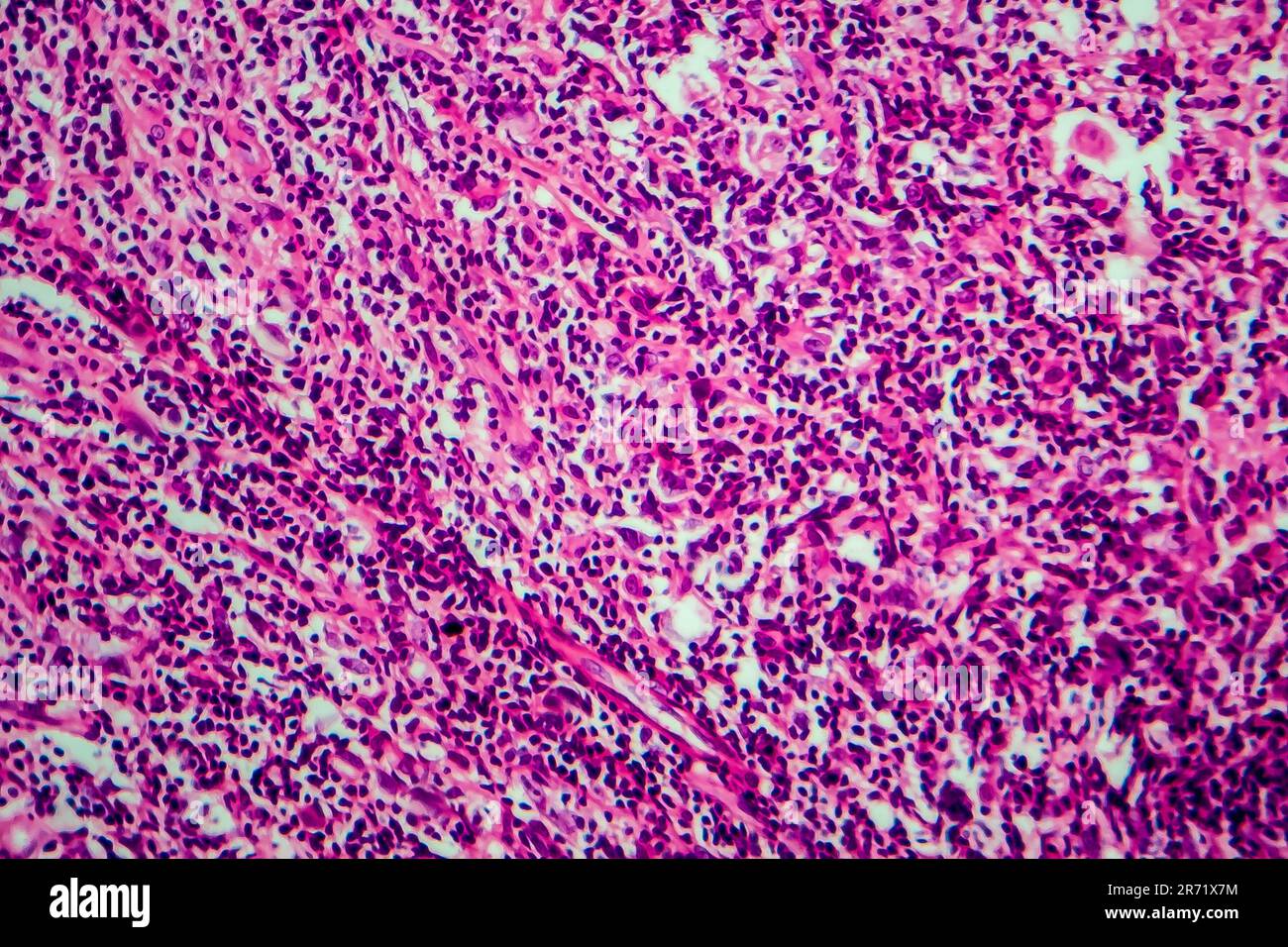 Hodgkin's lymphoma, light micrograph, photo under microscope Stock ...