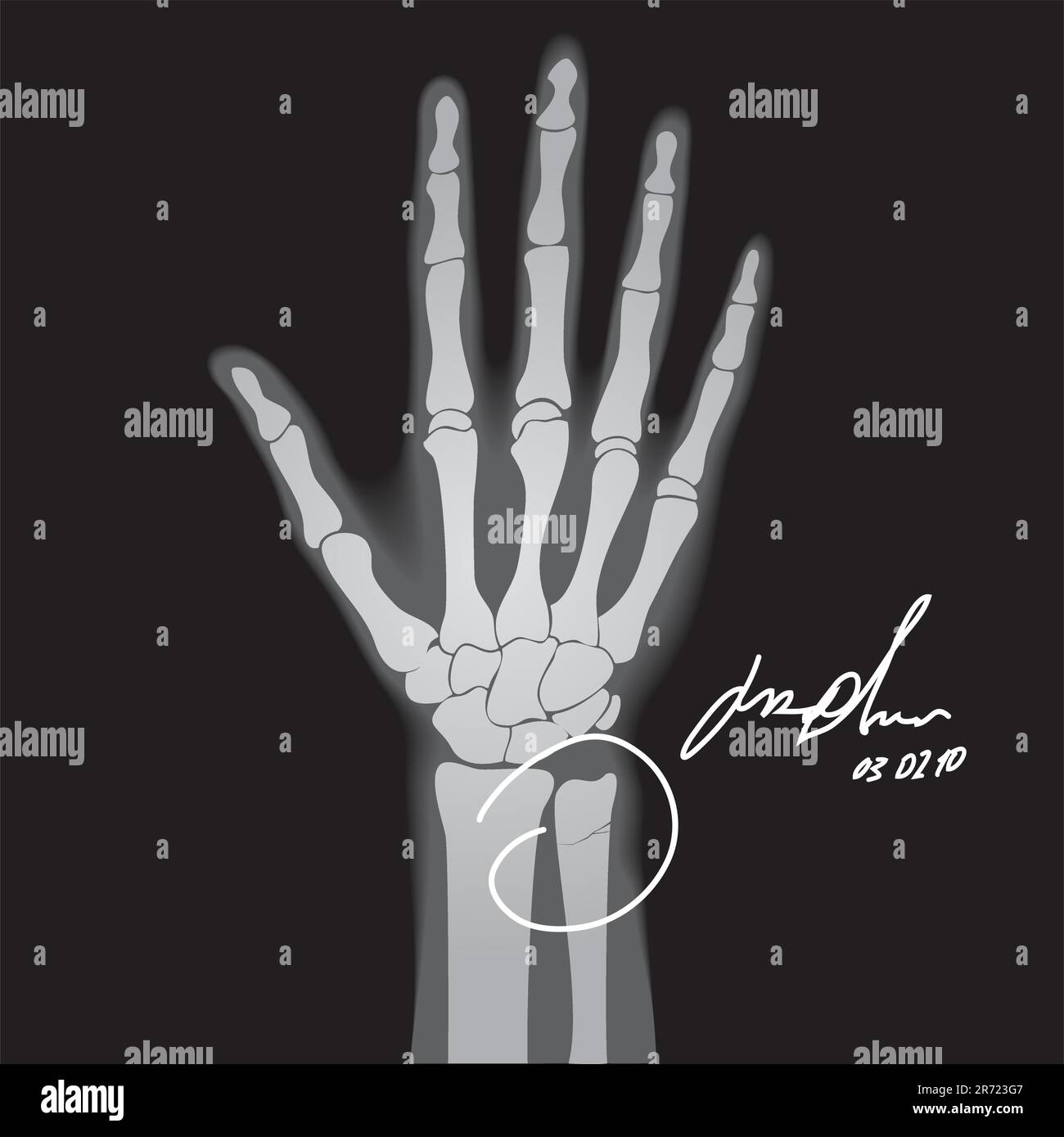 Broken bone fracture x ray Stock Vector Images - Alamy
