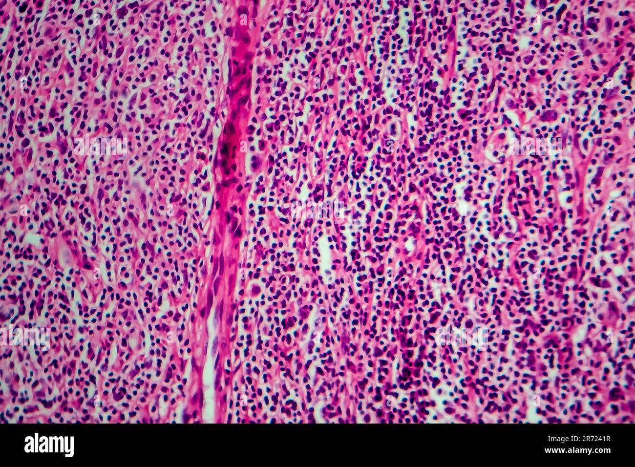 Hodgkin's lymphoma, light micrograph, photo under microscope Stock ...