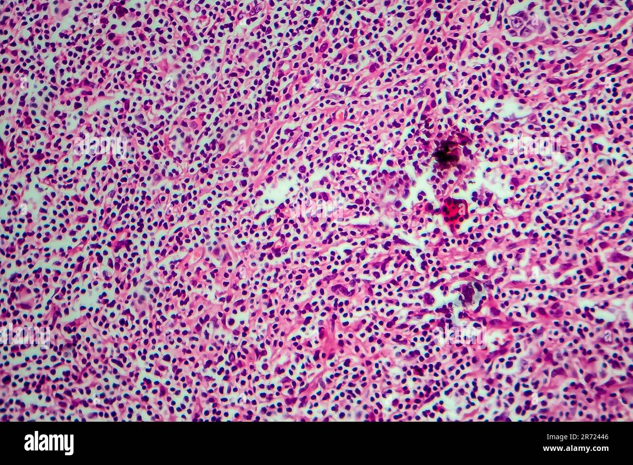 Hodgkin's lymphoma, light micrograph, photo under microscope Stock ...