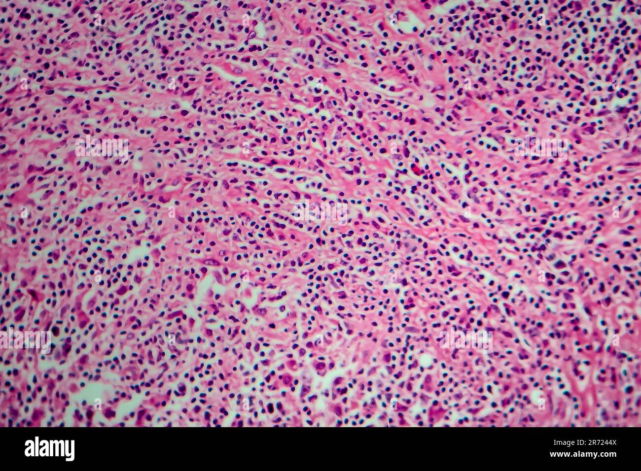 Hodgkin's lymphoma, light micrograph, photo under microscope Stock ...