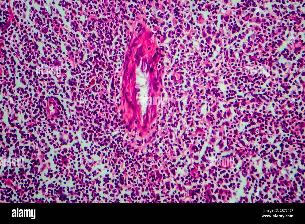 Hodgkin's lymphoma, light micrograph, photo under microscope Stock ...