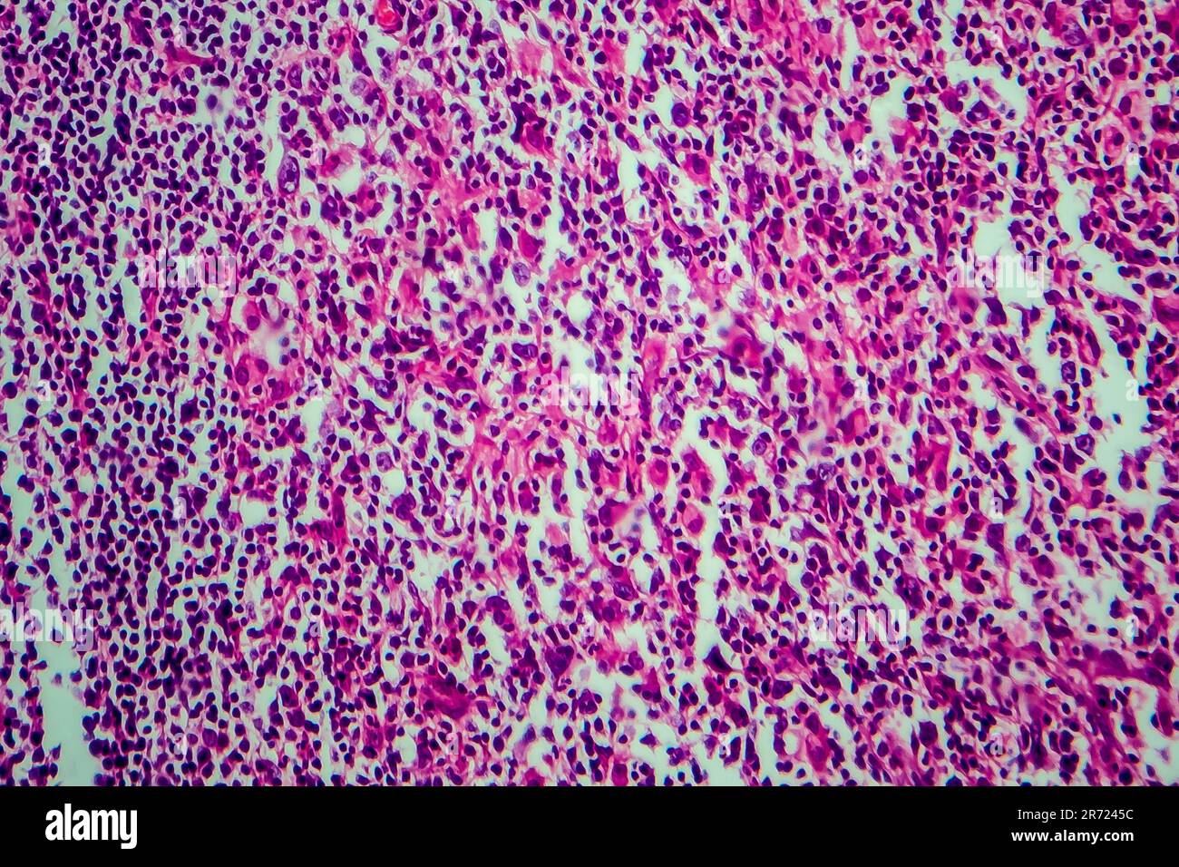 Hodgkin's lymphoma, light micrograph, photo under microscope Stock ...