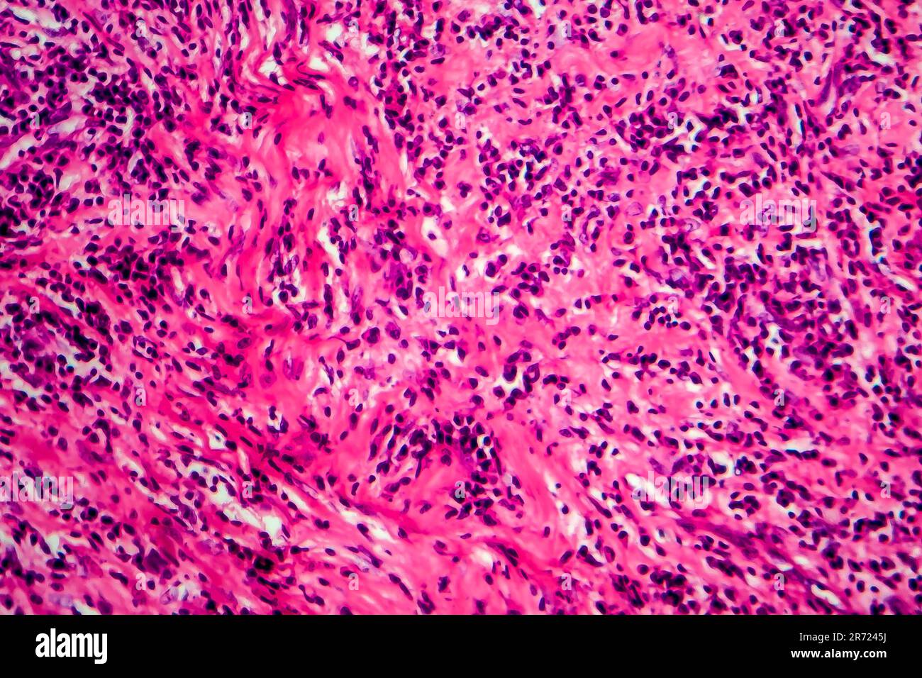 Hodgkin's lymphoma, light micrograph, photo under microscope Stock ...