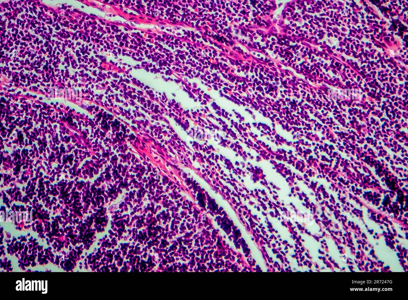 Hodgkin's lymphoma, light micrograph, photo under microscope Stock ...