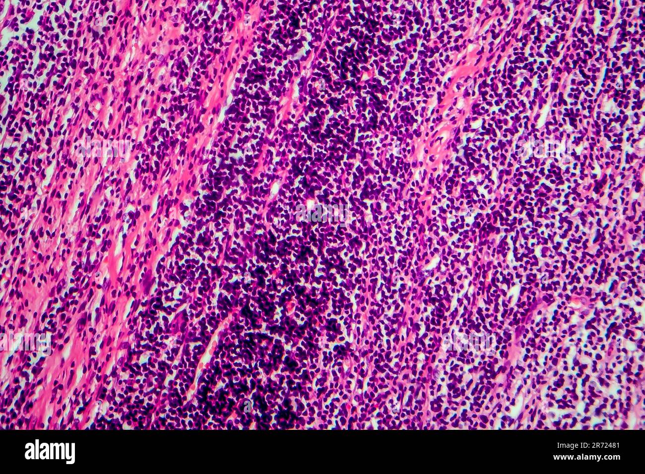 Hodgkin's lymphoma, light micrograph, photo under microscope Stock ...