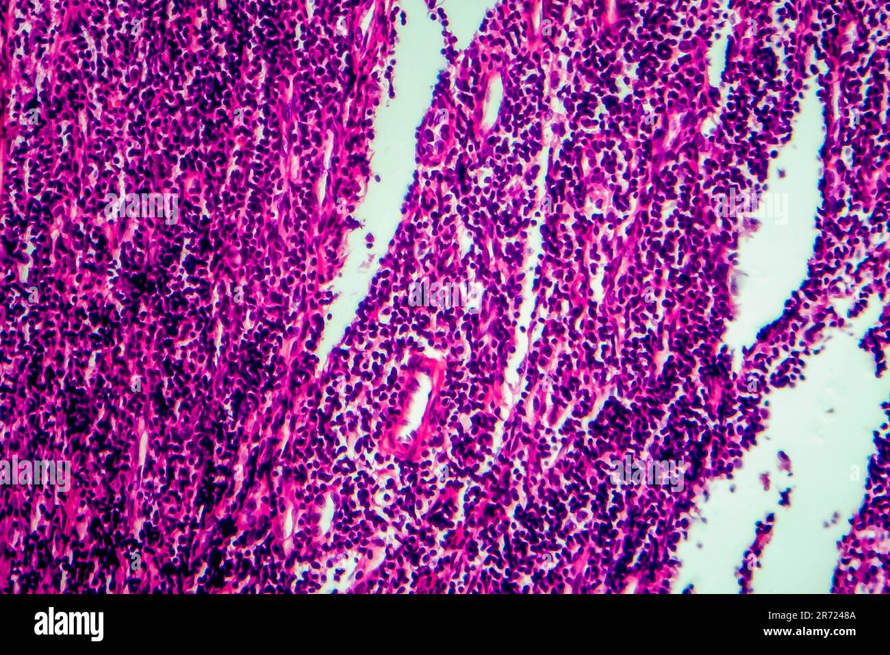 Hodgkin's lymphoma, light micrograph, photo under microscope Stock ...