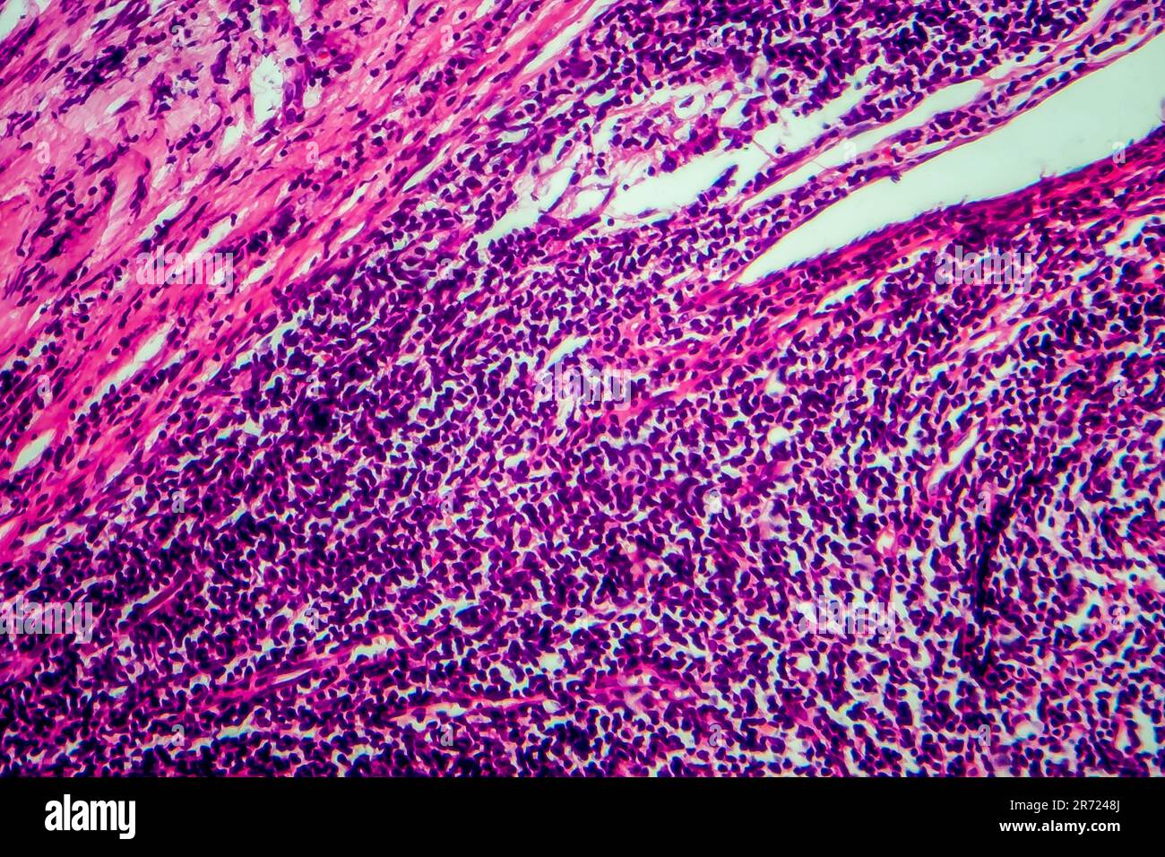 Hodgkin's lymphoma, light micrograph, photo under microscope Stock ...