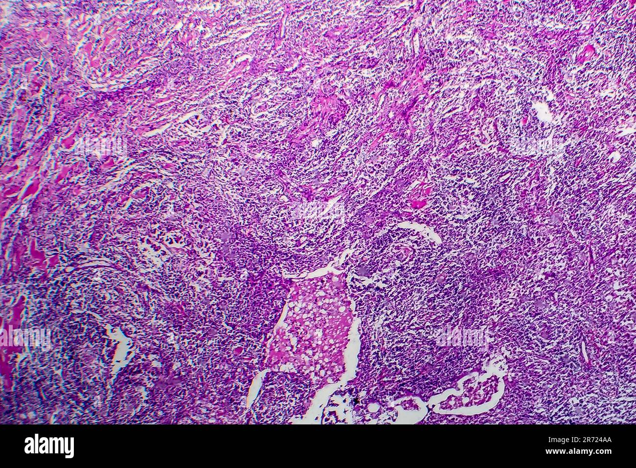 Hodgkin's lymphoma, light micrograph, photo under microscope Stock ...