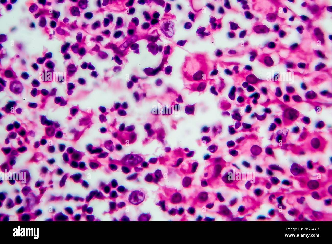 Hodgkin's lymphoma, light micrograph, photo under microscope Stock ...
