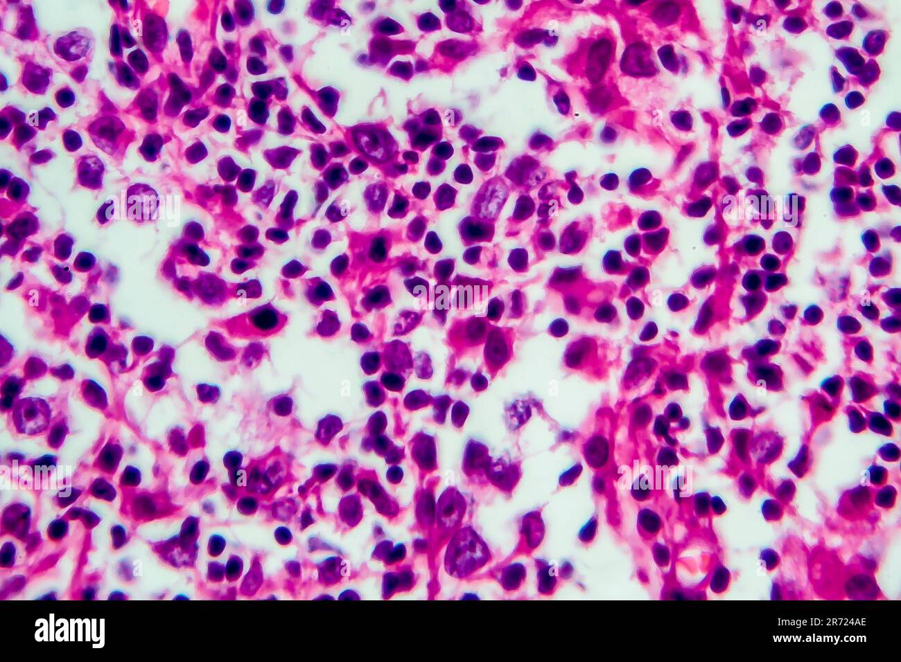 Hodgkin's lymphoma, light micrograph, photo under microscope Stock ...
