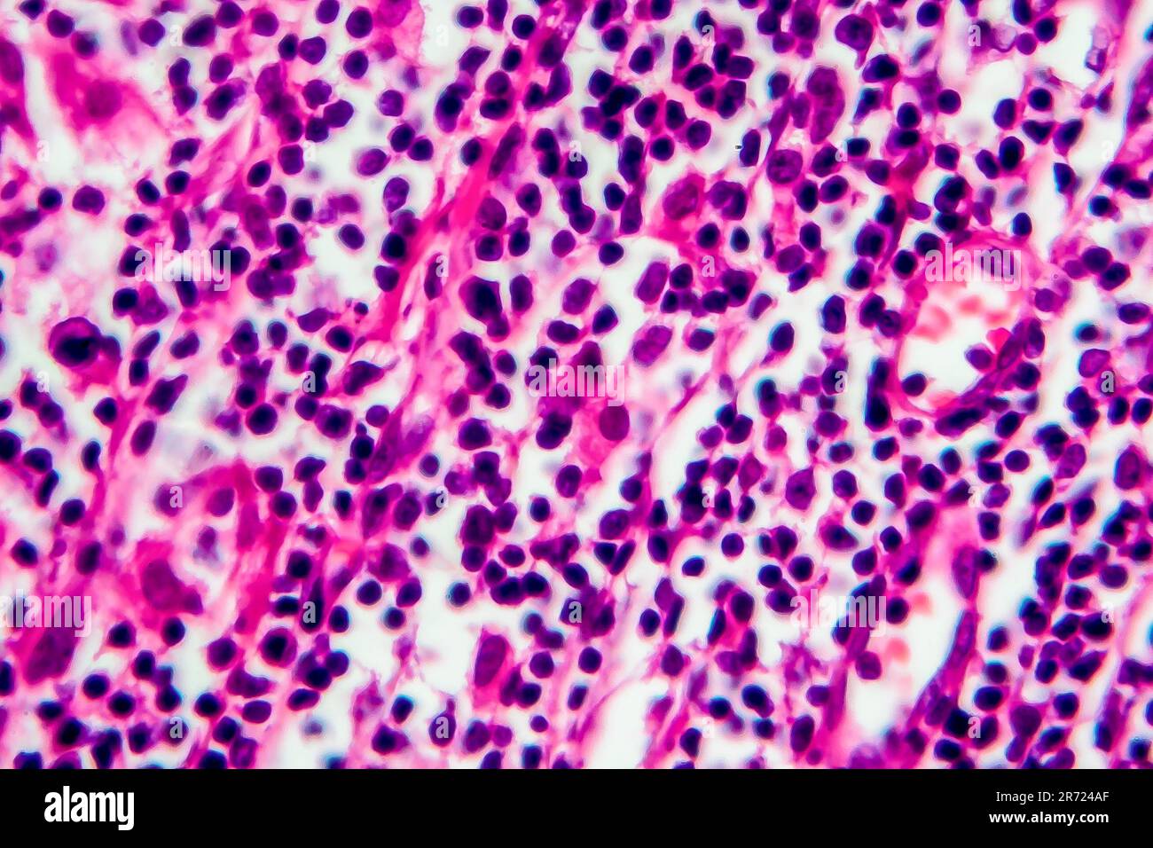 Hodgkin's lymphoma, light micrograph, photo under microscope Stock ...