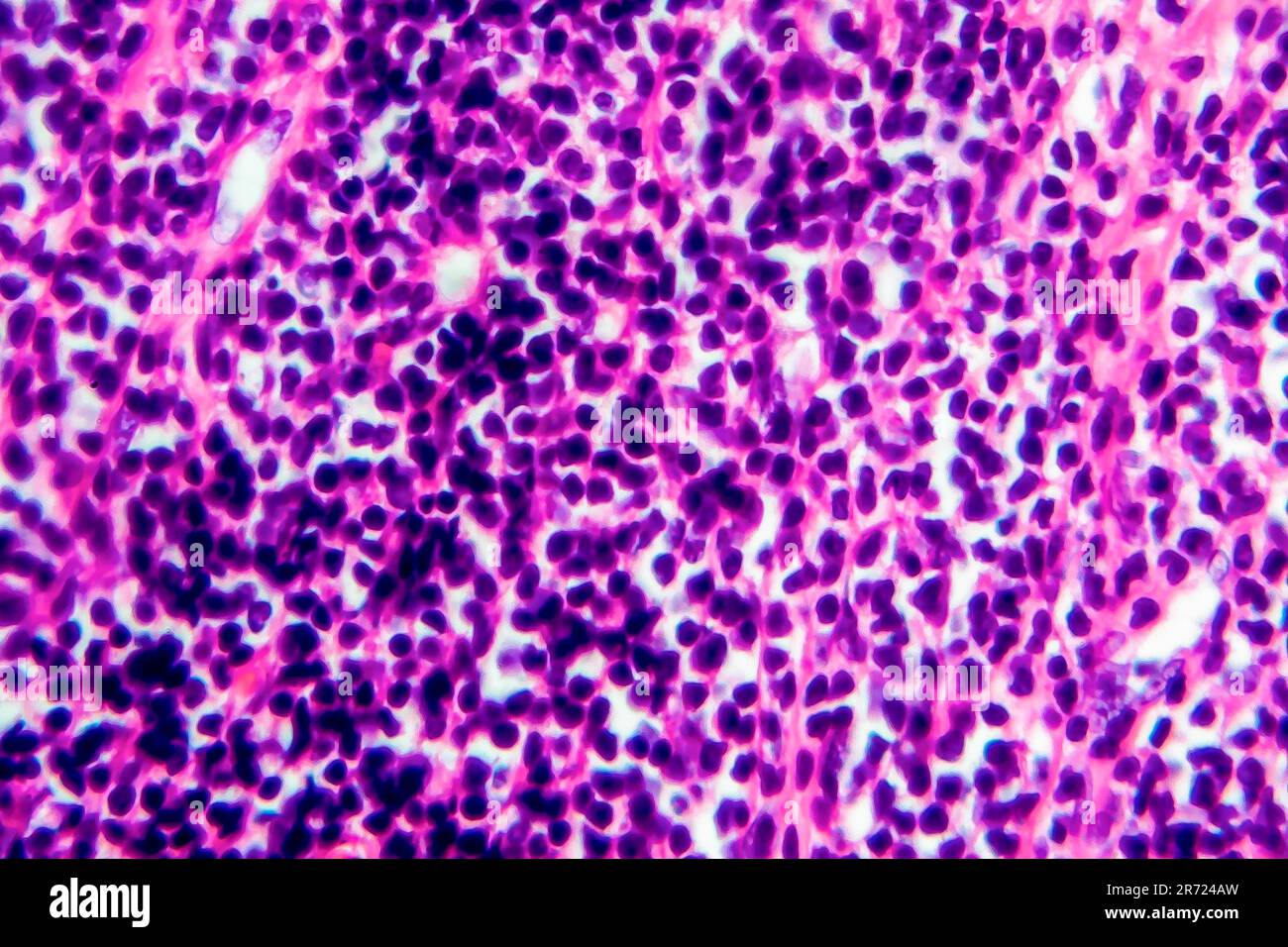 Hodgkin's lymphoma, light micrograph, photo under microscope Stock ...