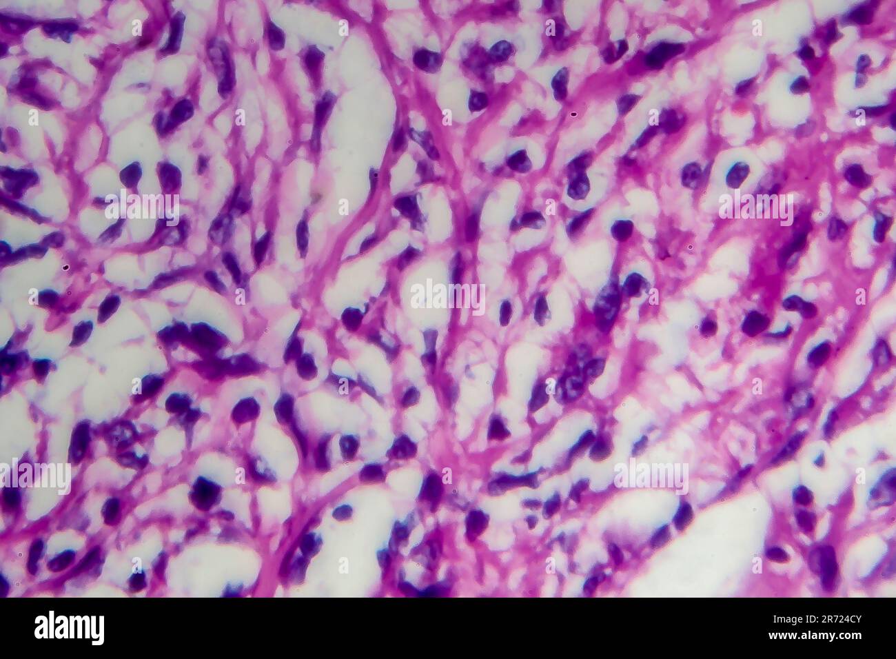 Hodgkin's lymphoma, light micrograph, photo under microscope. High ...