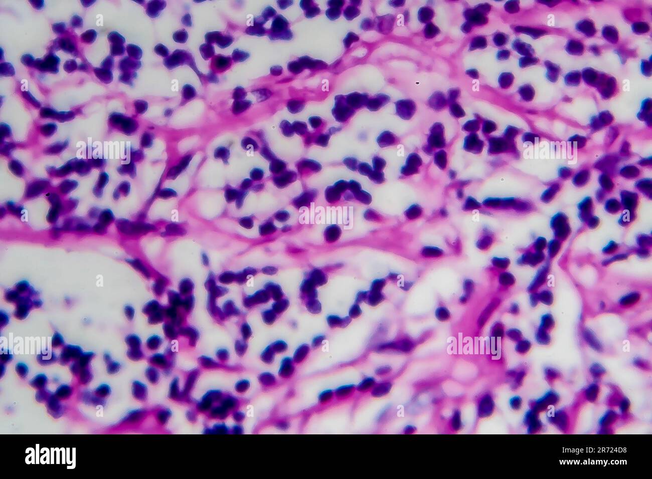 Hodgkin's lymphoma, light micrograph, photo under microscope. High ...