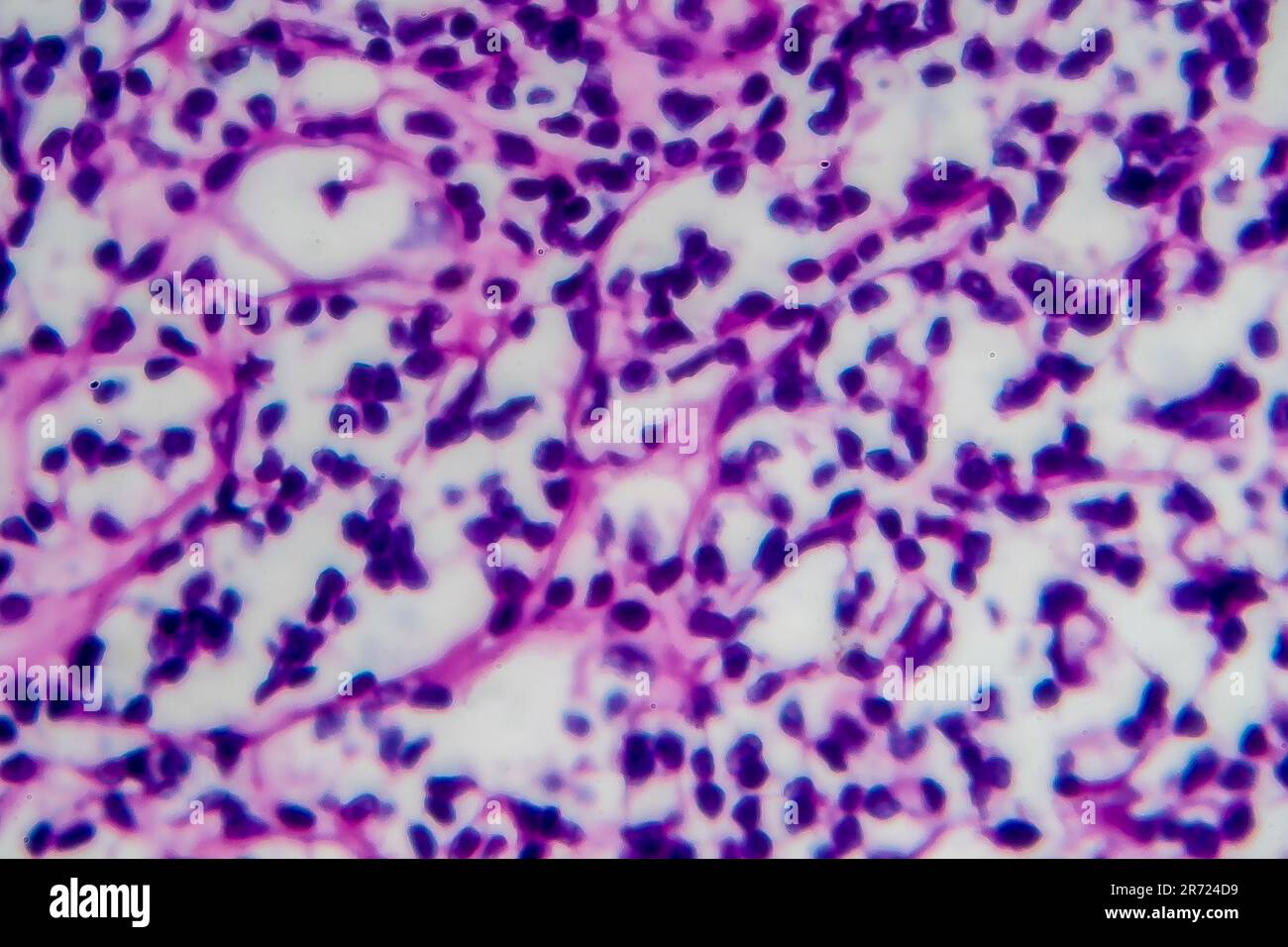 Hodgkin's lymphoma, light micrograph, photo under microscope. High ...
