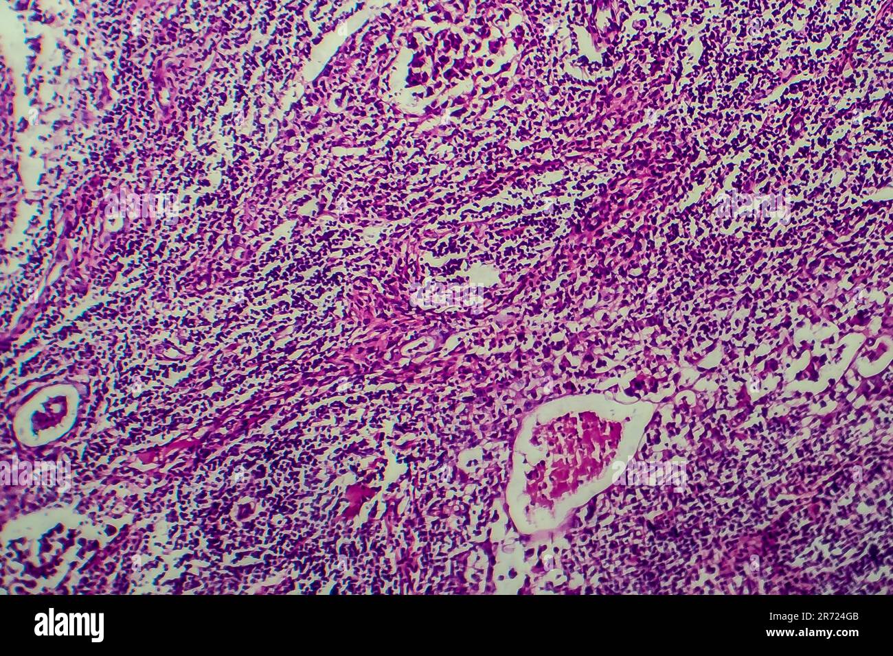 Hodgkin's lymphoma, light micrograph, photo under microscope Stock ...