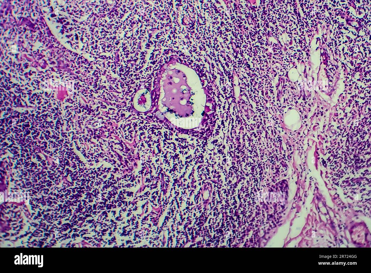 Hodgkin's lymphoma, light micrograph, photo under microscope Stock ...