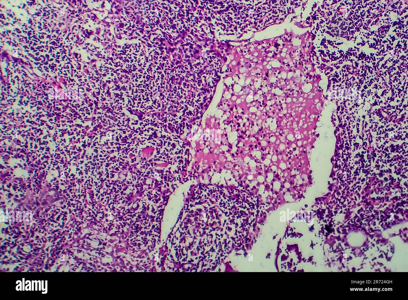 Hodgkin's lymphoma, light micrograph, photo under microscope Stock ...