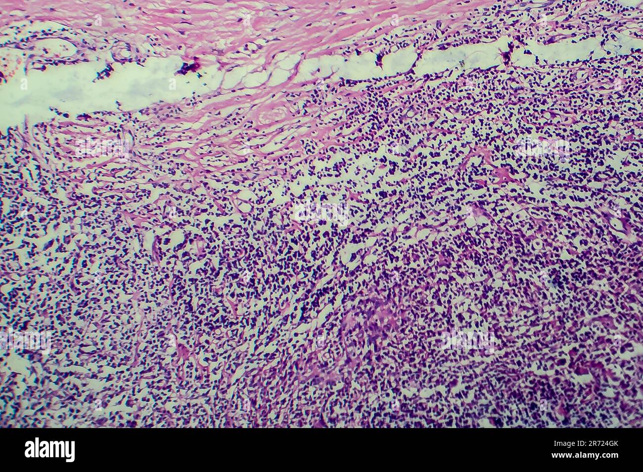 Hodgkin's lymphoma, light micrograph, photo under microscope Stock ...