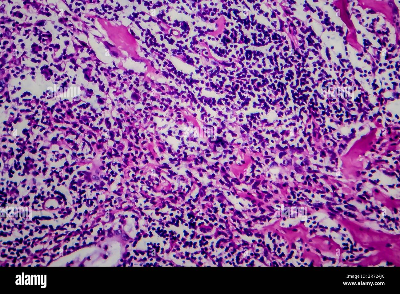 Hodgkin's lymphoma, light micrograph, photo under microscope Stock ...
