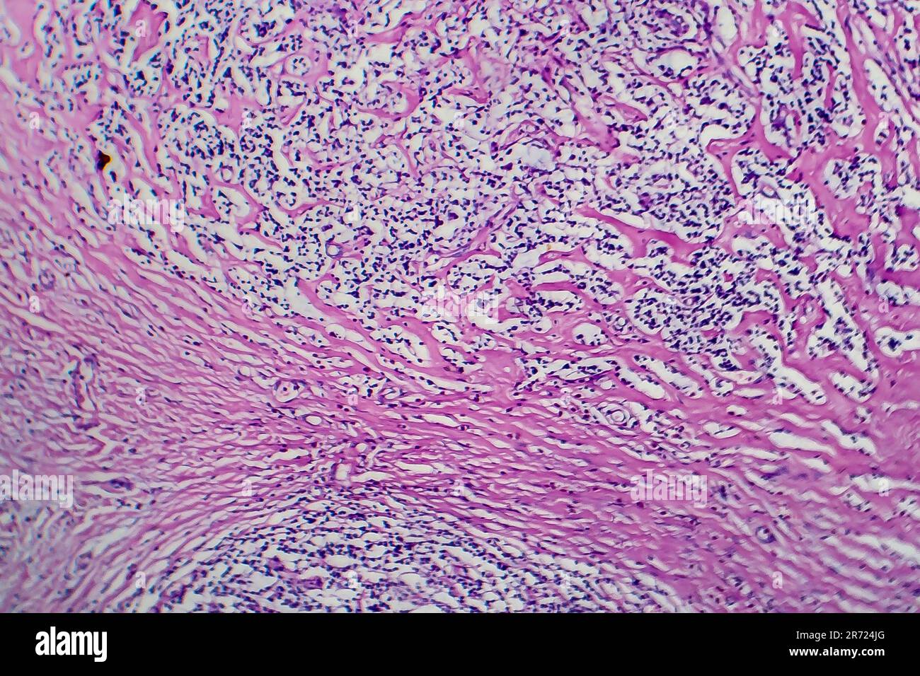 Hodgkin's lymphoma, light micrograph, photo under microscope Stock ...