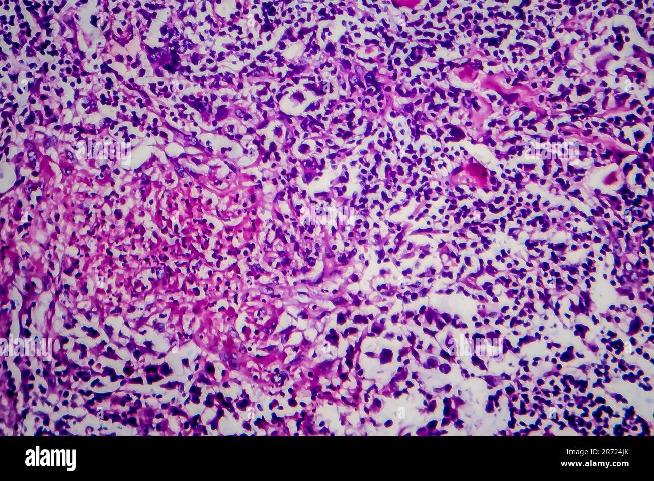 Hodgkin's lymphoma, light micrograph, photo under microscope Stock ...