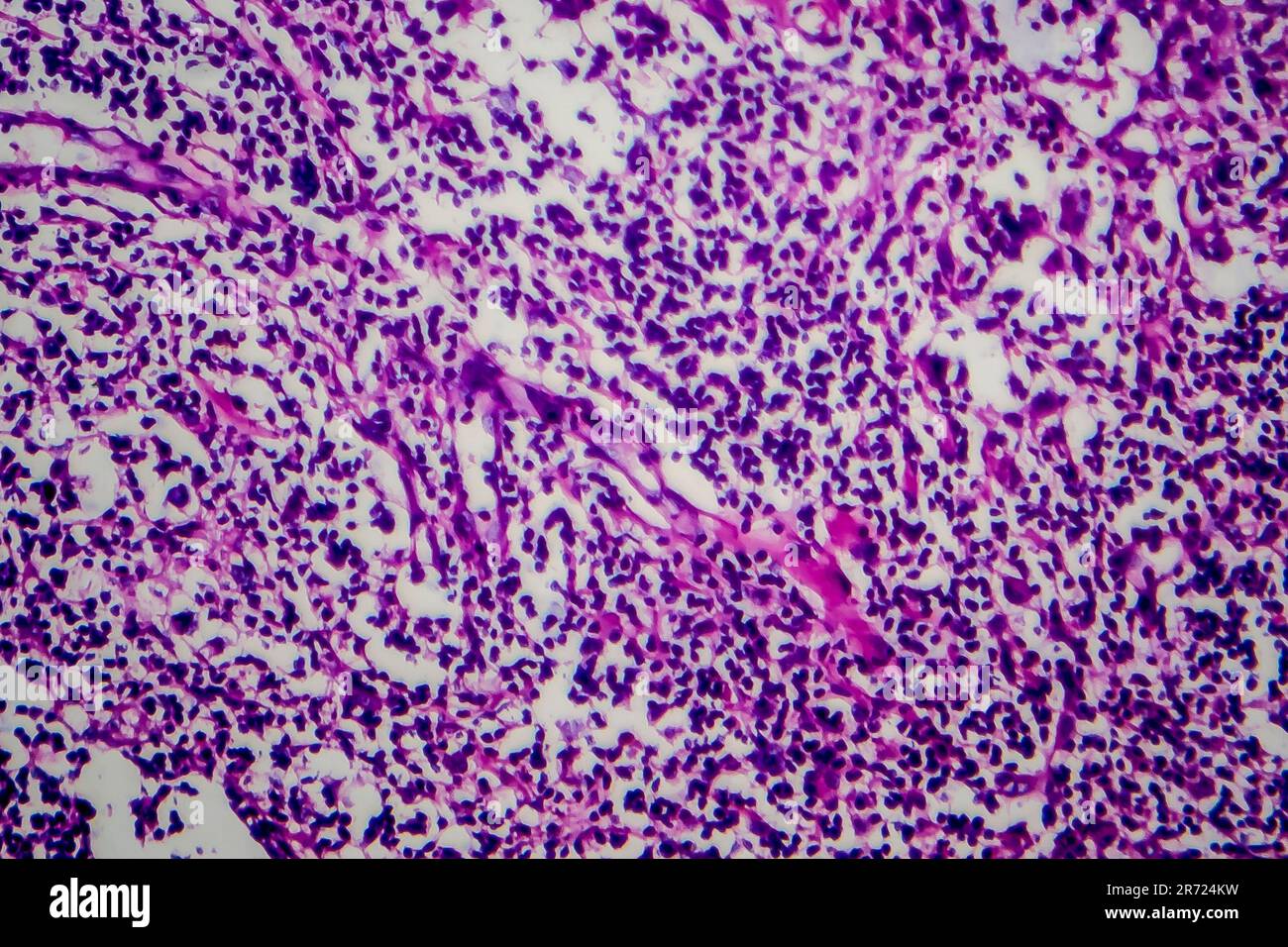 Hodgkin's lymphoma, light micrograph, photo under microscope Stock ...
