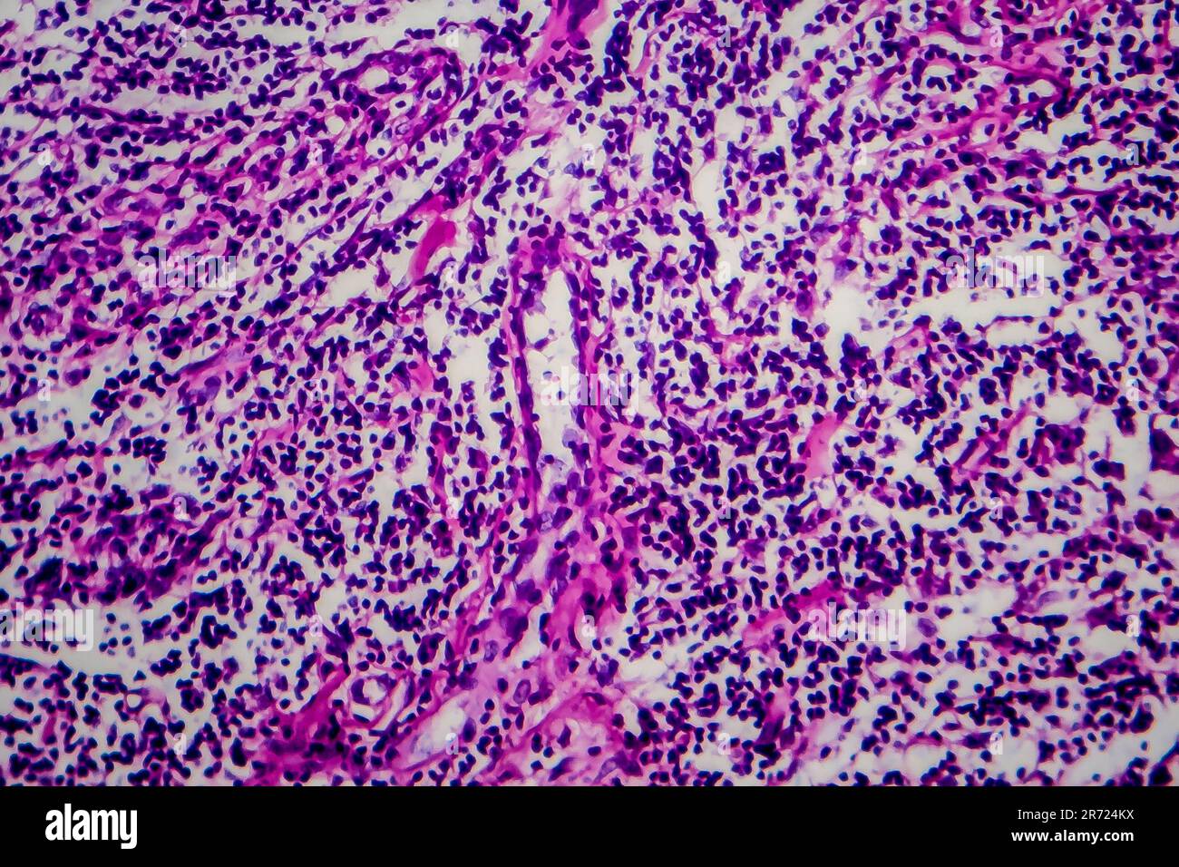 Hodgkin's lymphoma, light micrograph, photo under microscope Stock ...