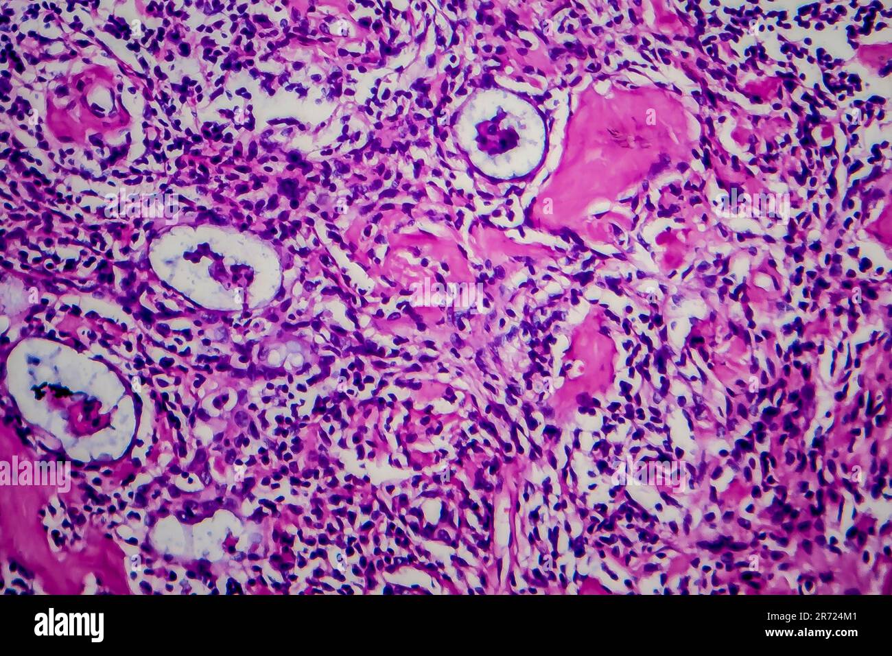Hodgkin's lymphoma, light micrograph, photo under microscope Stock ...