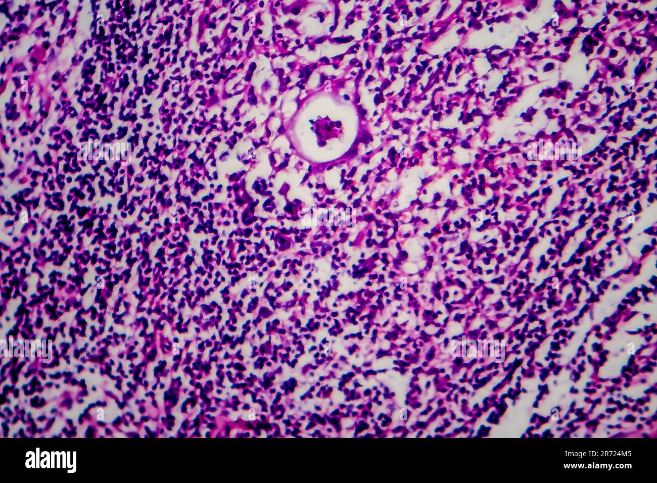 Hodgkin's lymphoma, light micrograph, photo under microscope Stock ...