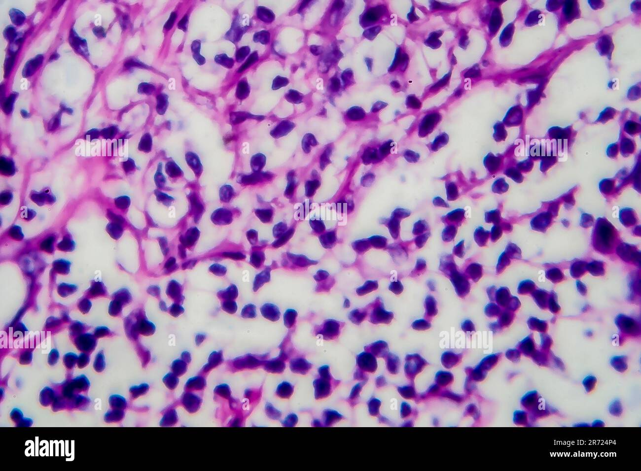 Hodgkin's lymphoma, light micrograph, photo under microscope. High ...