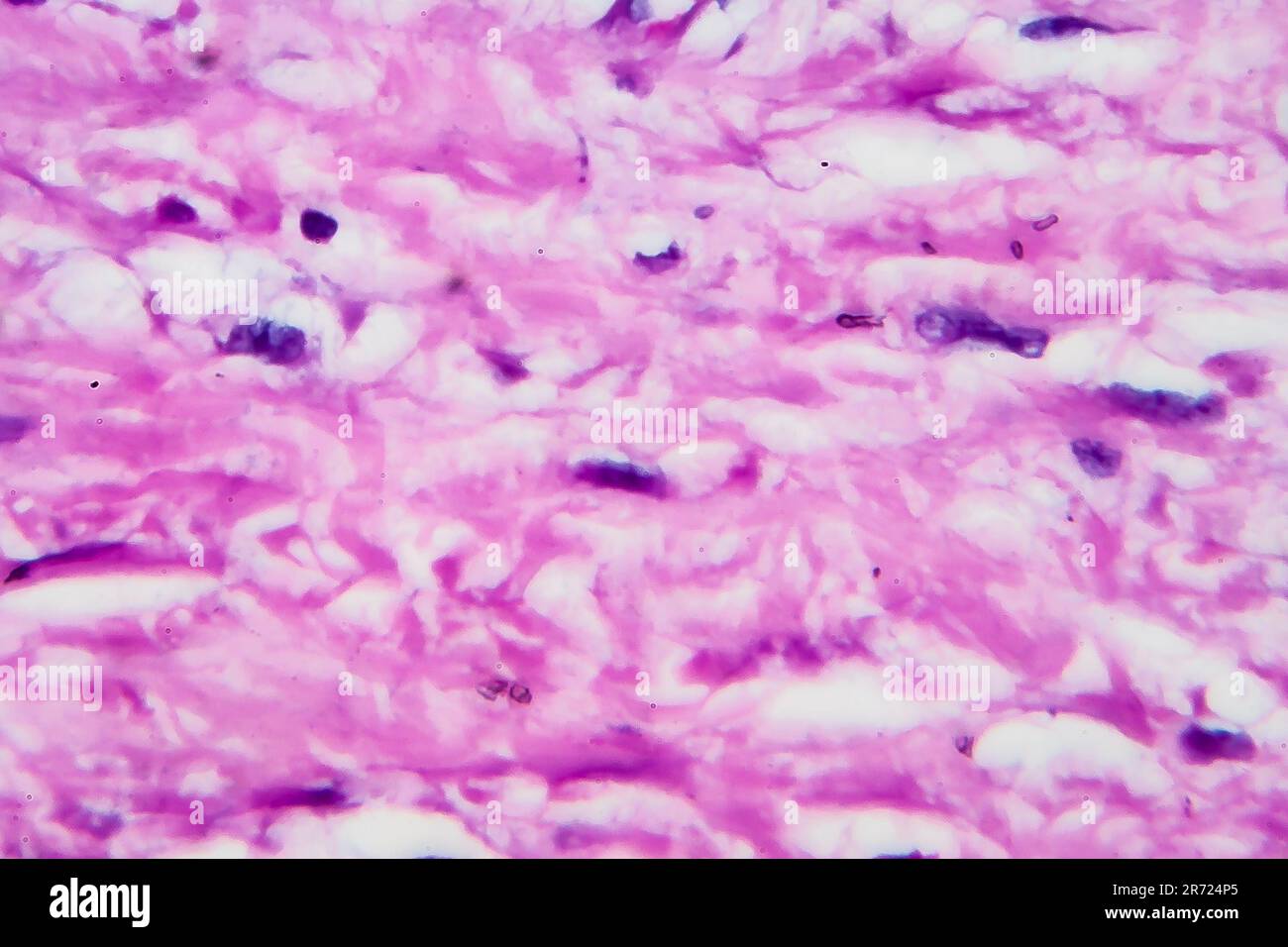 Hodgkin's lymphoma, light micrograph, photo under microscope. High ...