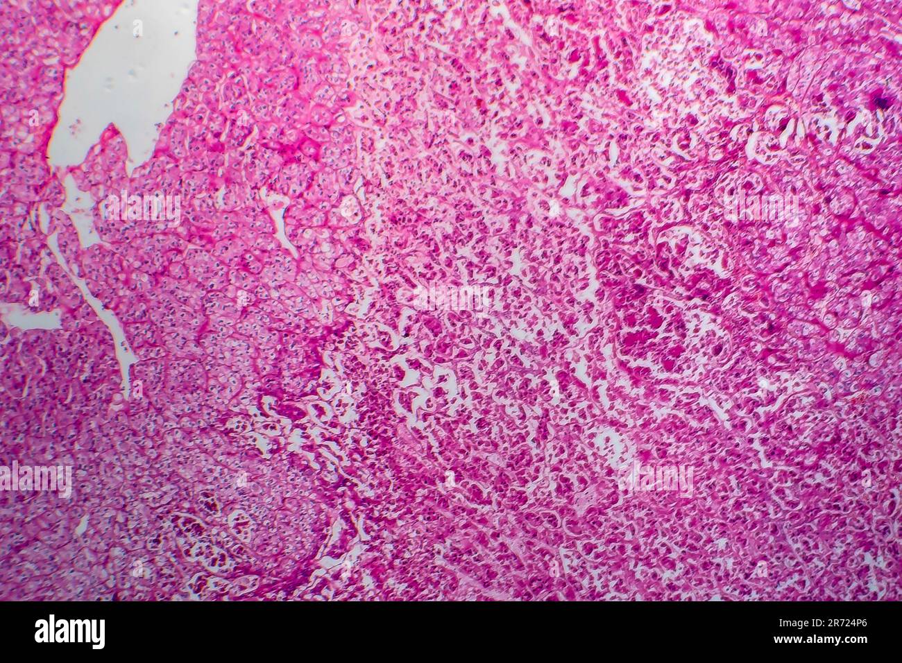 Renal cell carcinoma, light micrograph, photo under microscope Stock ...