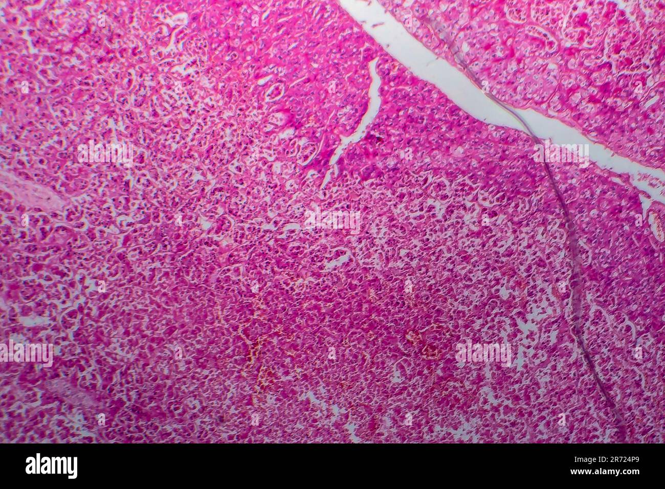 Renal cell carcinoma, light micrograph, photo under microscope Stock ...