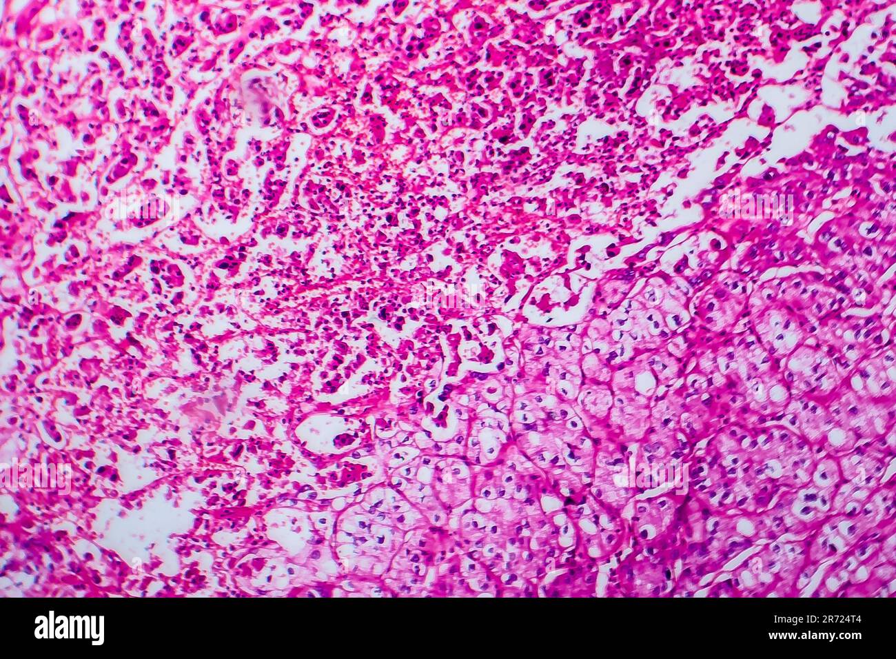 Renal cell carcinoma, light micrograph, photo under microscope Stock ...