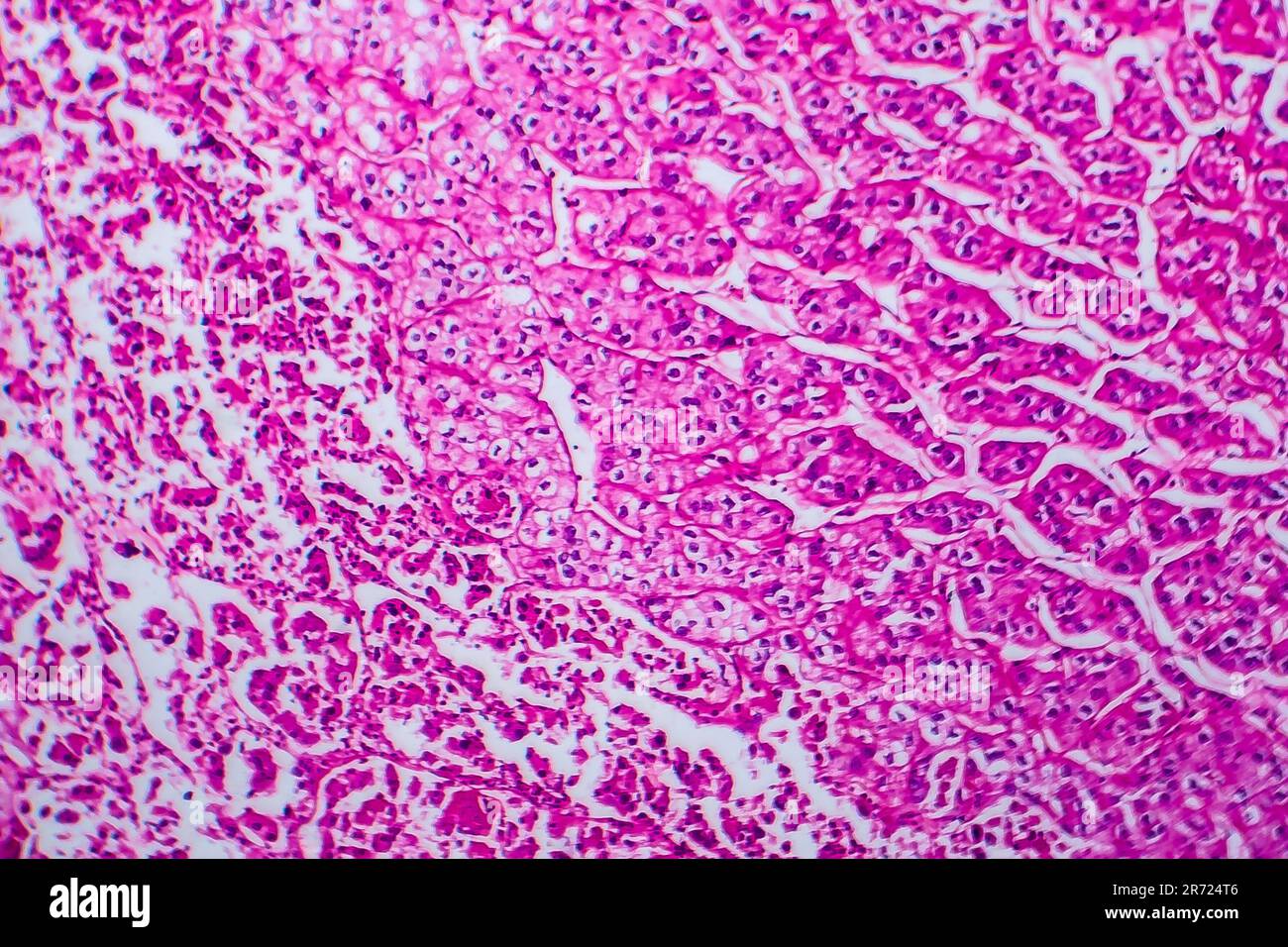 Renal cell carcinoma, light micrograph, photo under microscope Stock ...