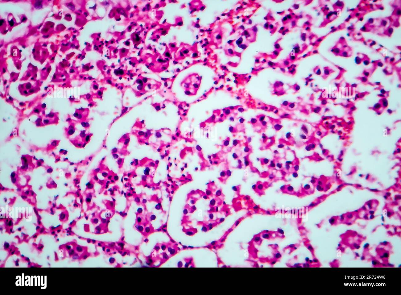 Renal cell carcinoma, light micrograph, photo under microscope Stock ...