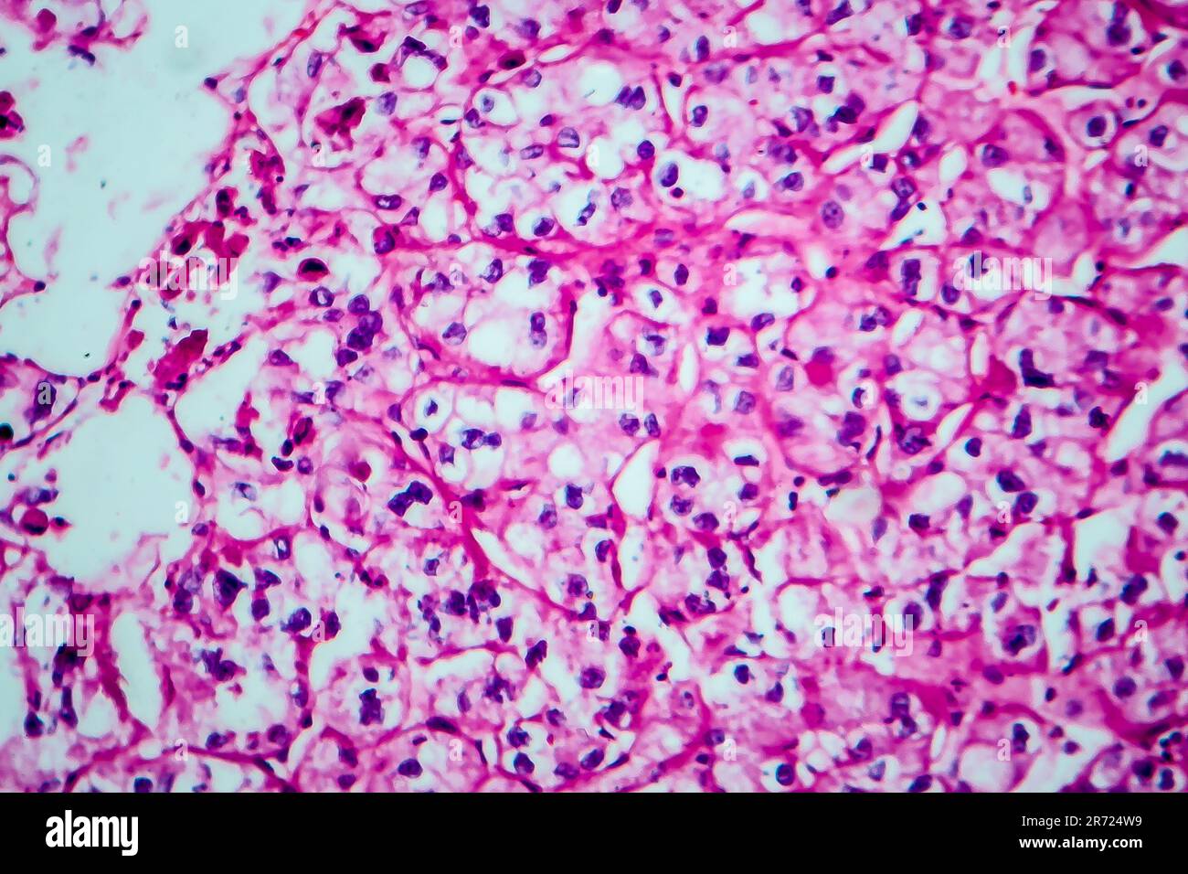 Renal cell carcinoma, light micrograph, photo under microscope Stock ...