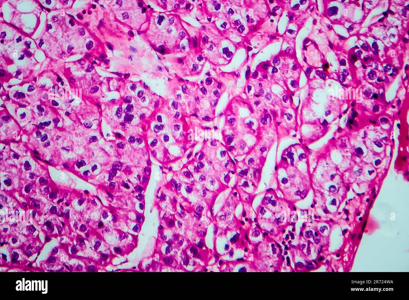 Renal cell carcinoma, light micrograph, photo under microscope Stock ...