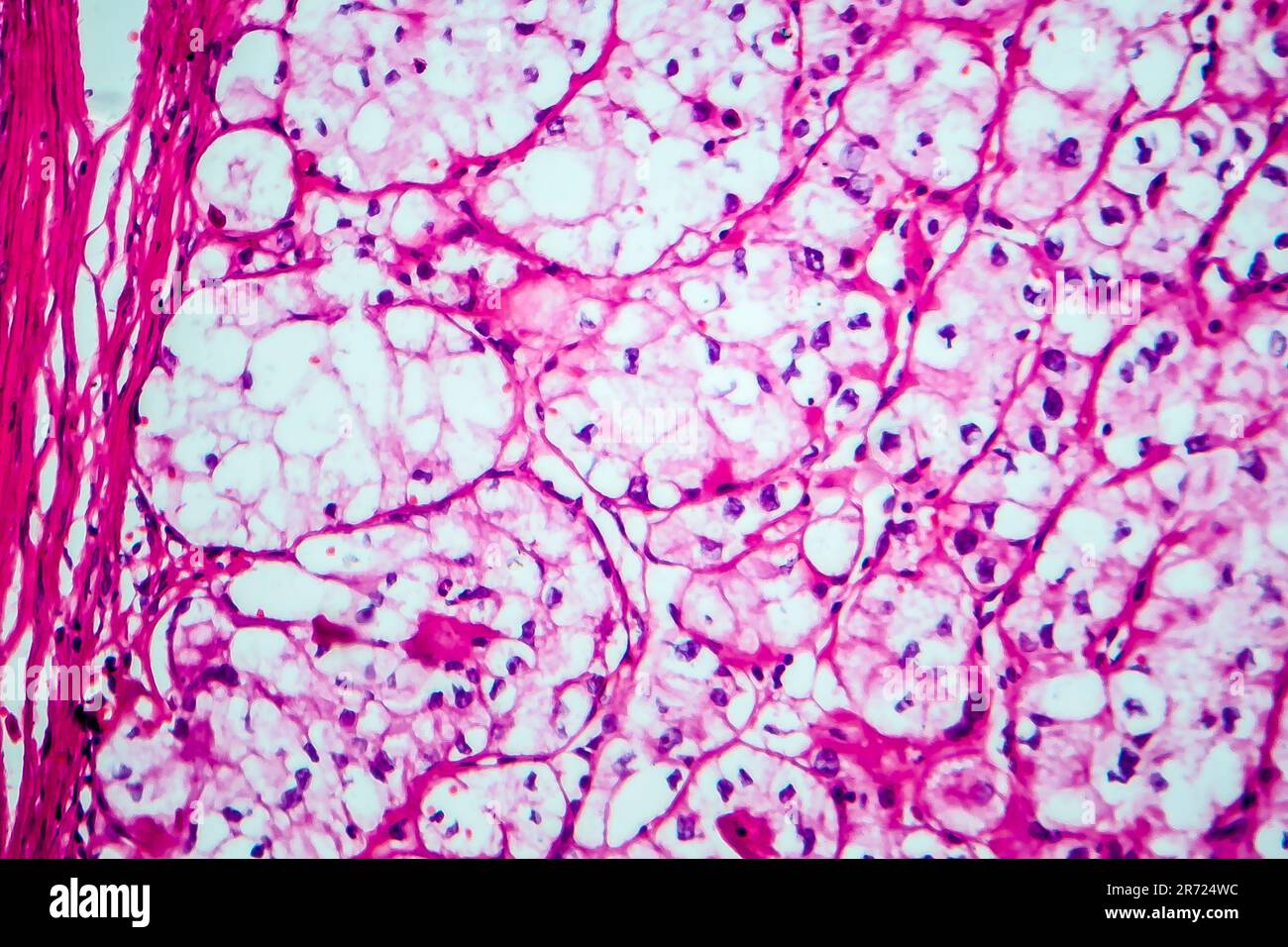 Renal cell carcinoma, light micrograph, photo under microscope Stock ...