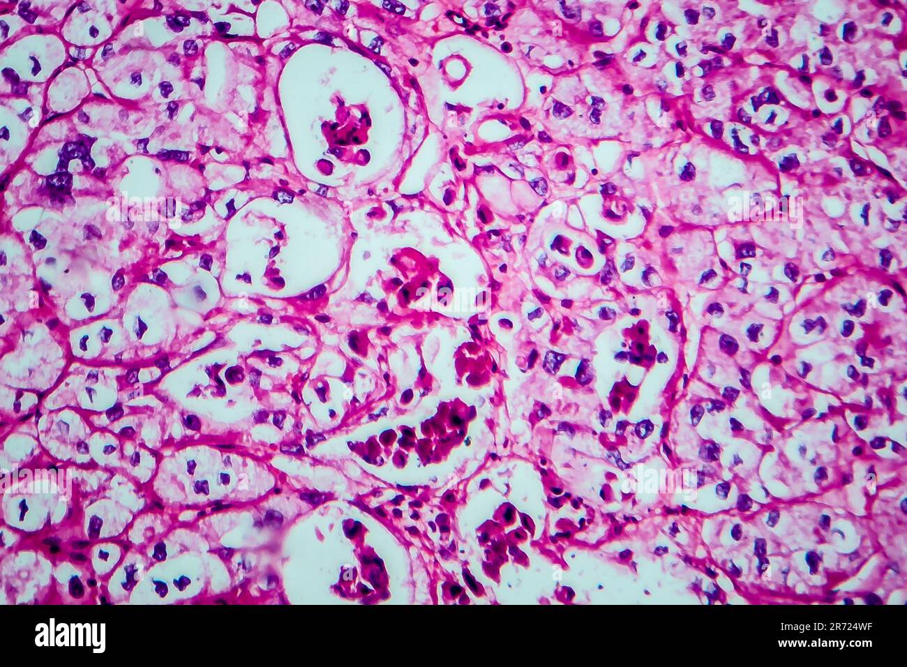 Renal cell carcinoma, light micrograph, photo under microscope Stock ...