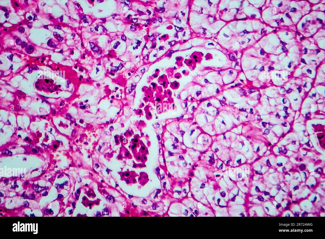 Renal cell carcinoma, light micrograph, photo under microscope Stock ...