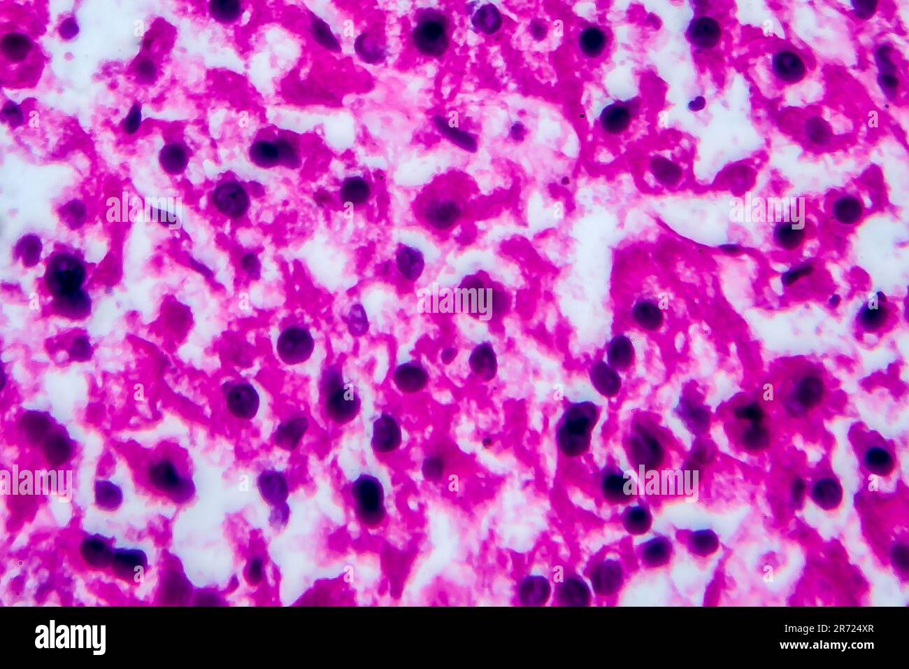 Renal cell carcinoma, light micrograph, photo under microscope. High ...