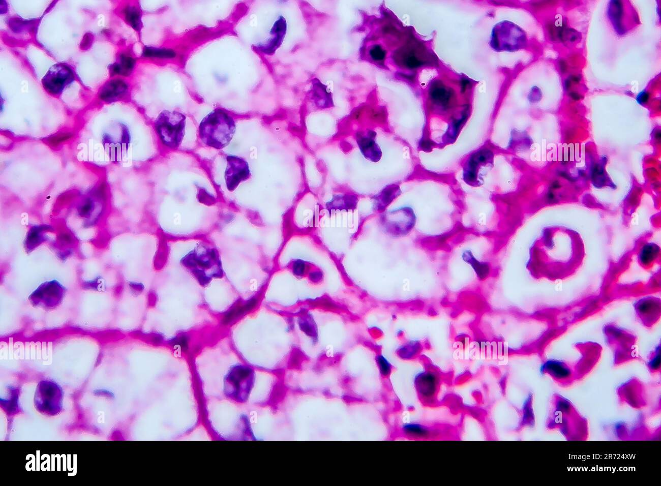 Renal cell carcinoma, light micrograph, photo under microscope. High ...