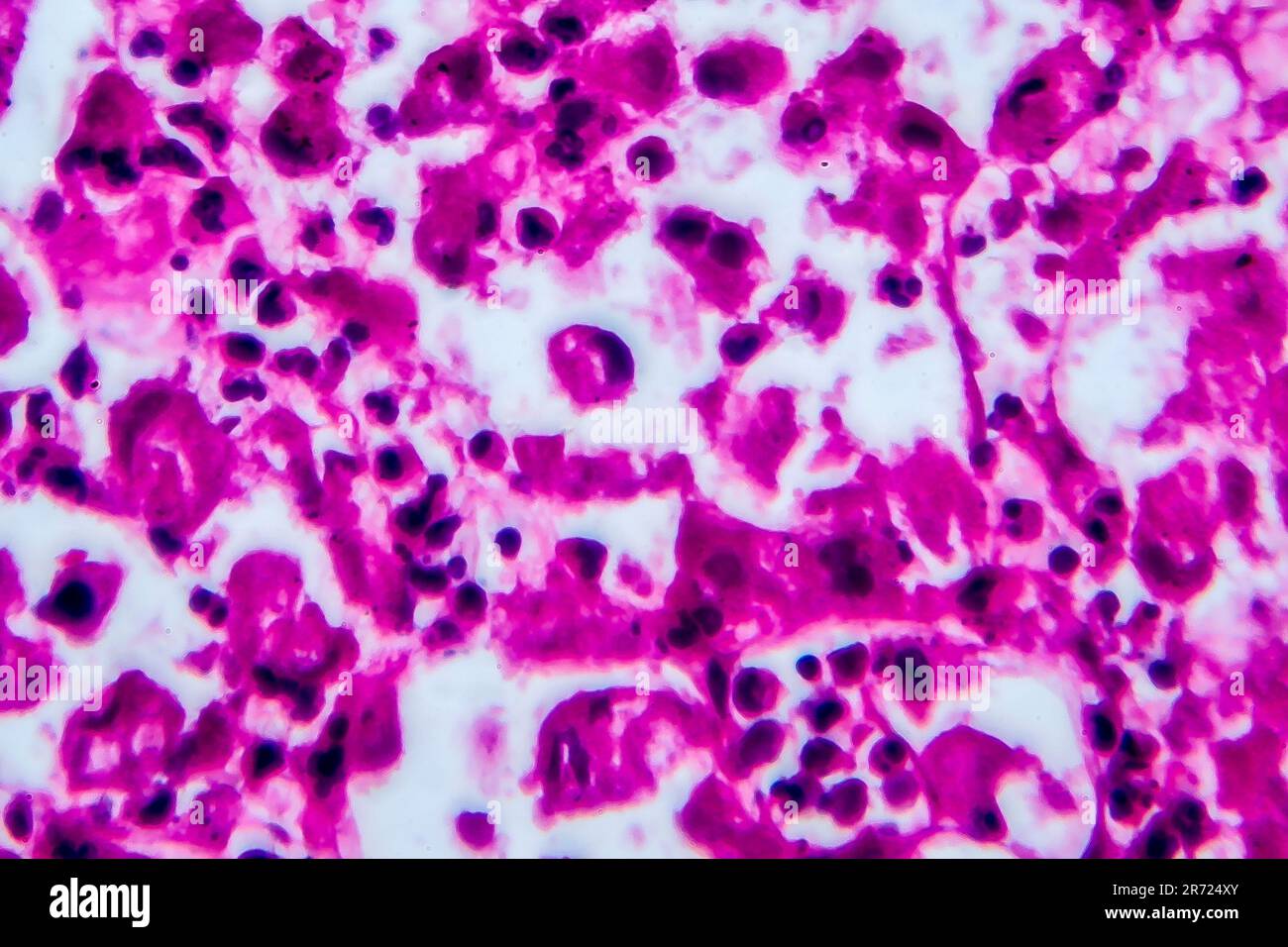 Renal cell carcinoma, light micrograph, photo under microscope. High ...